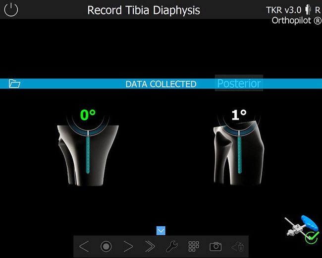 Total Knee Revision (TKR)
