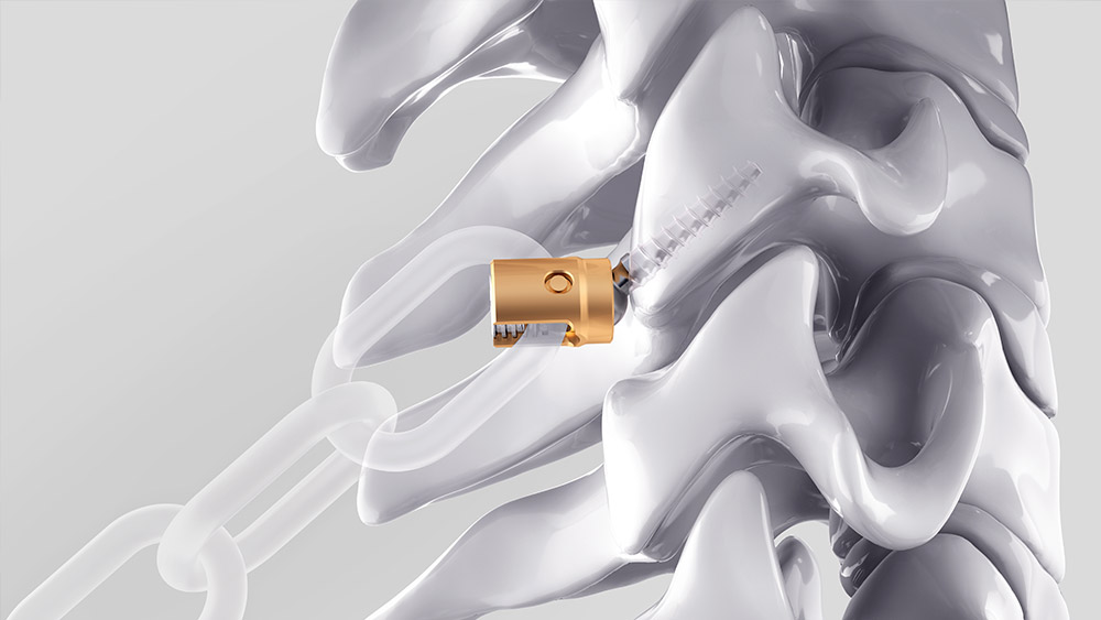 Ennovate® Cervical