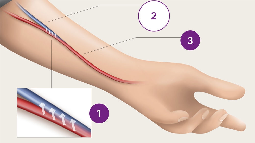 Hemodialysis: Unterstanding its Process - B. Braun