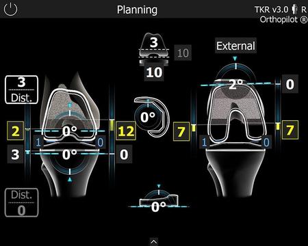 Total Knee Revision (TKR) - B. Braun