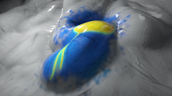 EinsteinVision® 3.0 FI 3D camera system in laparoscopic surgery - B. Braun