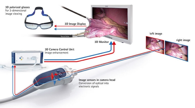 3D Technology in Laparoscopy - B. Braun