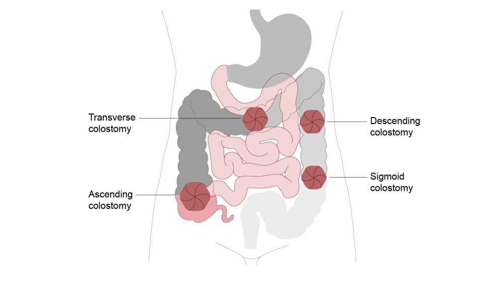 What is a Stoma? Stoma Function and Types Explained - B. Braun