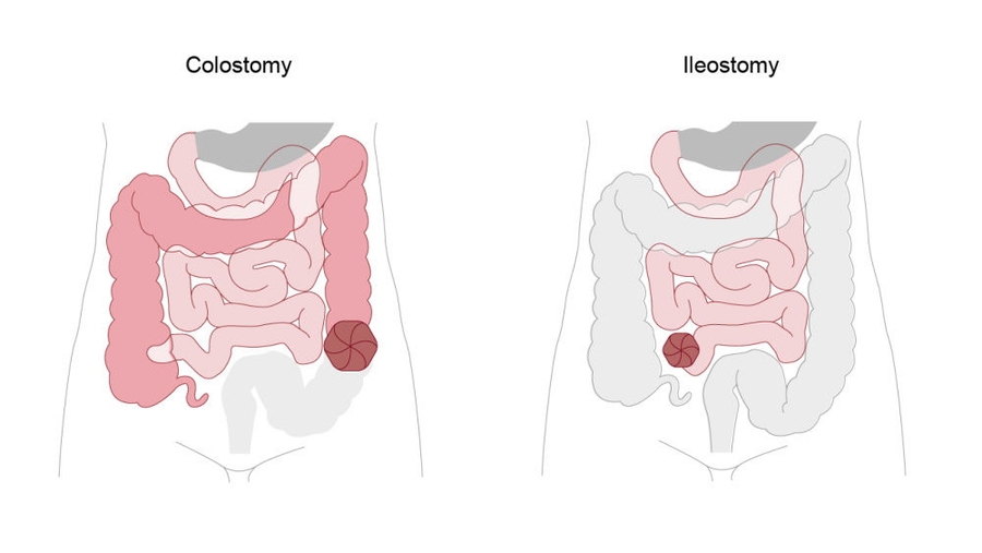 What is a Stoma? Stoma Function and Types Explained - B. Braun
