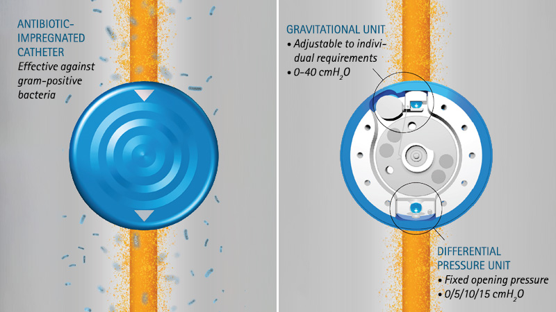 MIETHKE M.blue® – Adjustable gravitational valve for the treatment of ...