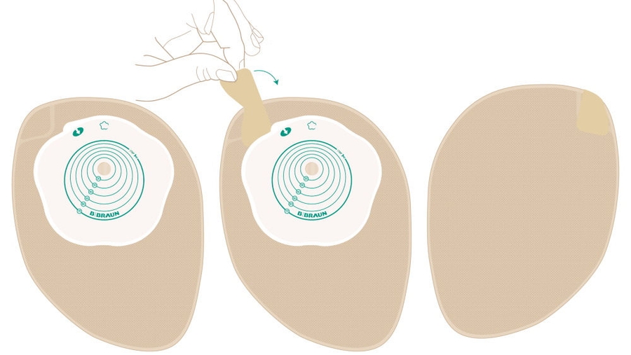 Swimming with Stoma: The Right Ostomy Swimwear - B. Braun