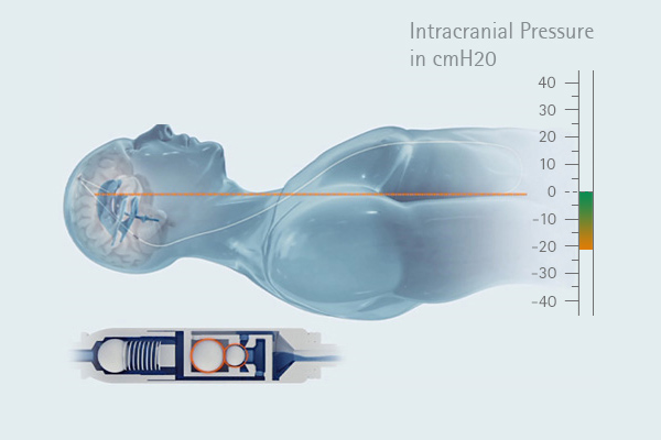 Treating Hydrocephalus