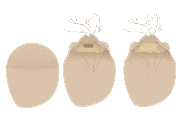 Swimming With a Stoma: The Right Ostomy Swimwear