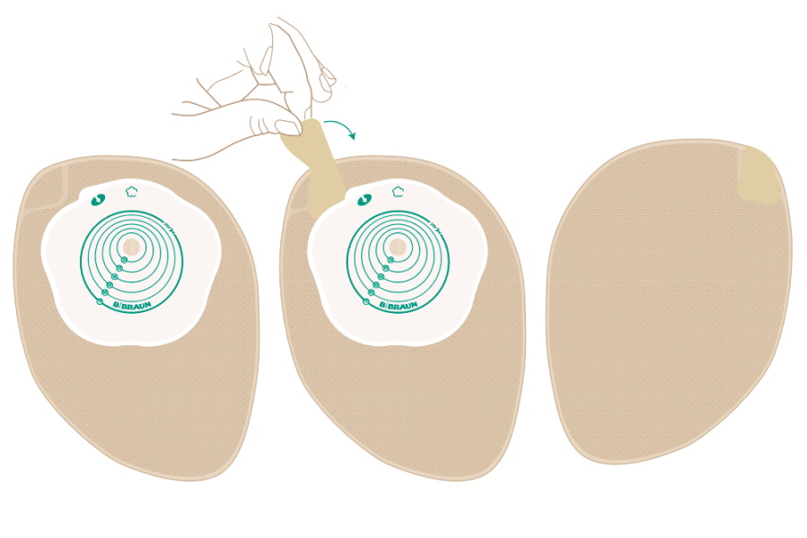 Swimming With a Stoma: The Right Ostomy Swimwear