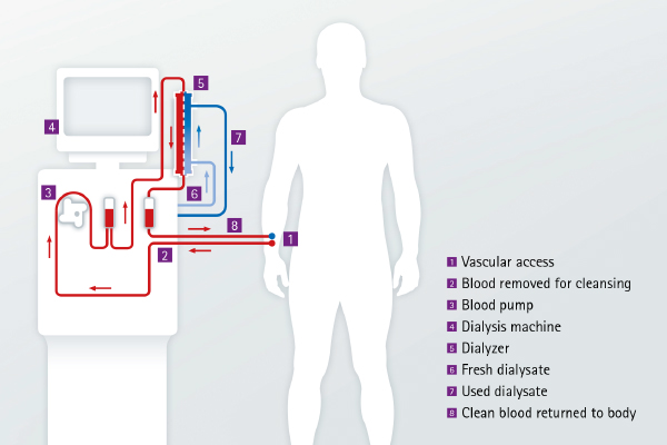 Hemodialysis Machine Diagram