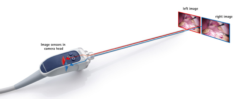 3D Technology in Laparoscopy