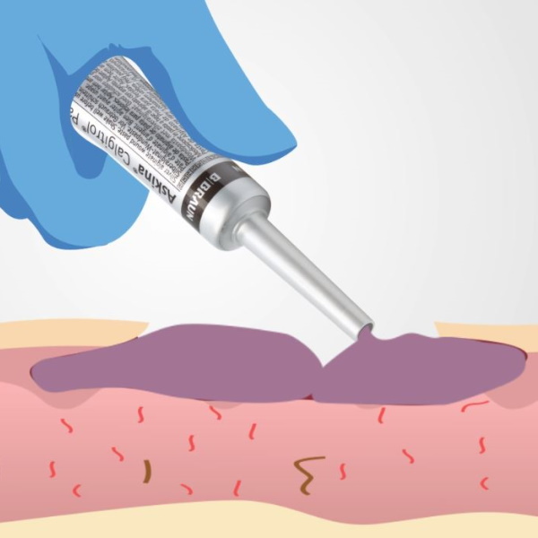 Silver dressings in wound care