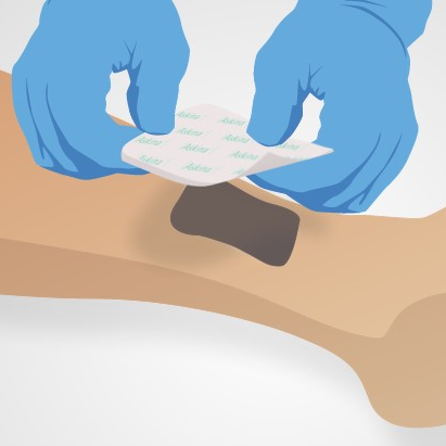 Silver dressings in wound care