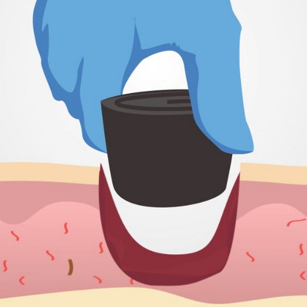 Silver dressings in wound care