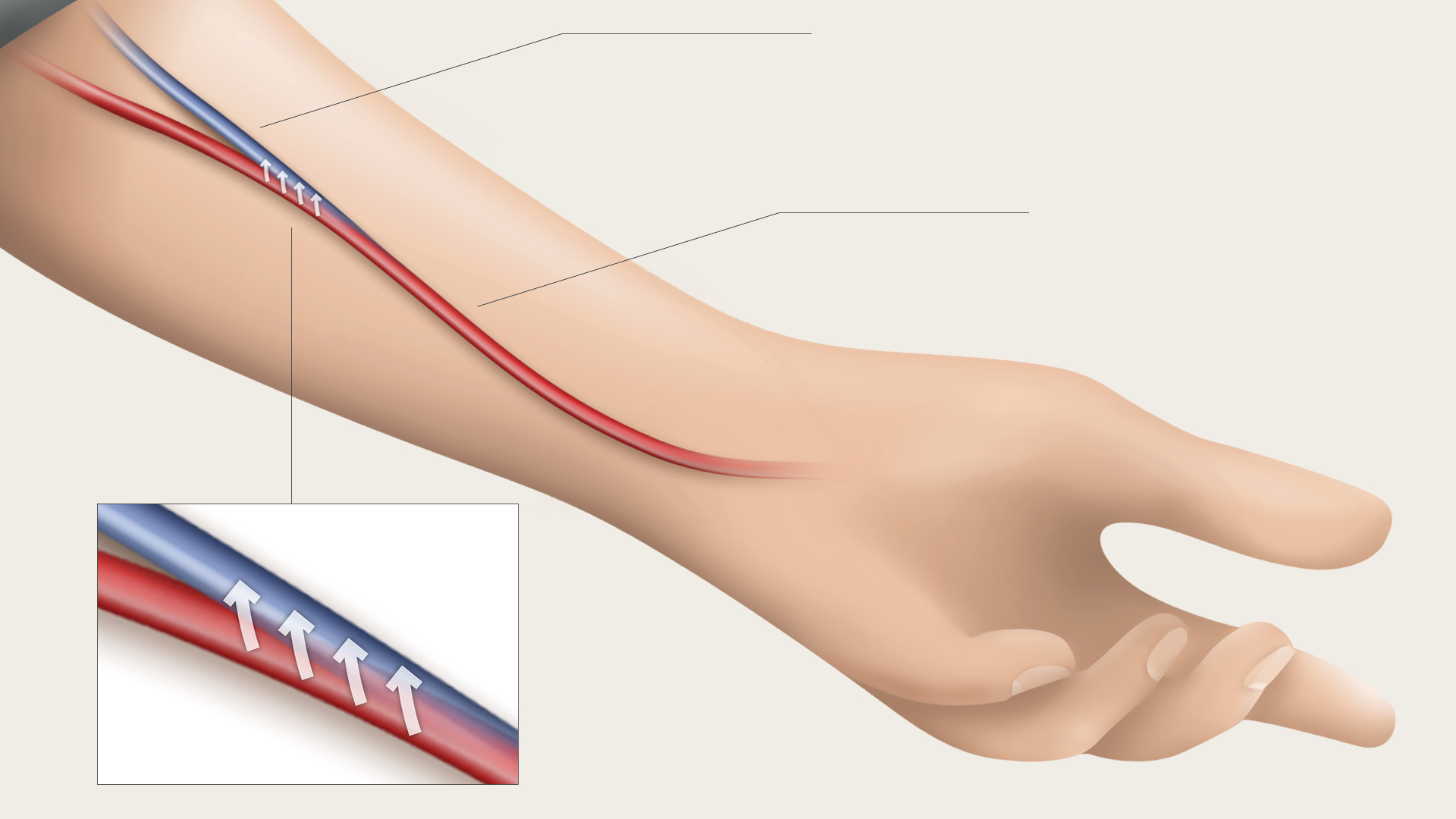Hemodialysis: Unterstanding its Process - B. Braun